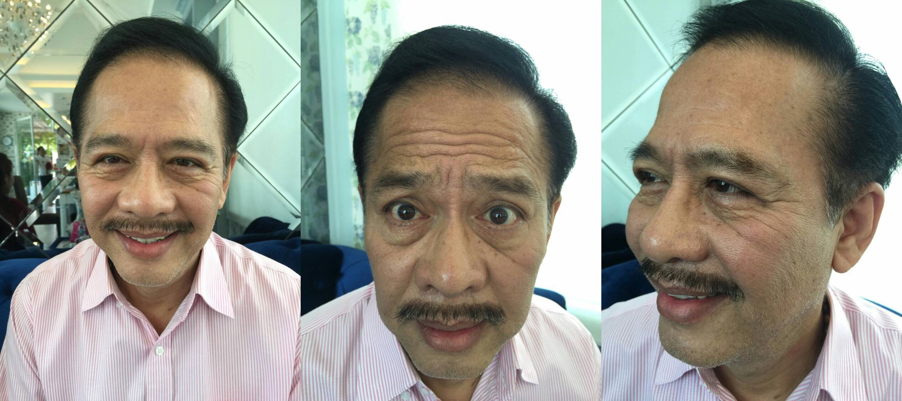 'สุรชัย' เตรียมเผยโฉมหลังผ่าตัด พฤหัสบดีนี้ได้เห็น!!