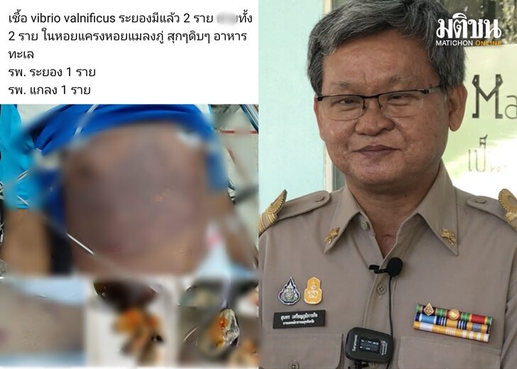 สสจ.ระยอง แจงโซเชียลแชร์ผู้ป่วยติดเชื้อแบคทีเรียกินเนื้อ ภาพเก่าปี 61